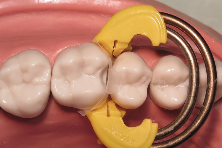 Bioclear – Lowman Family Dental