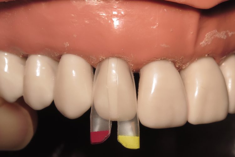 Bioclear – Lowman Family Dental